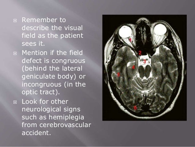 Common Cases: Neurological Visual Field defects