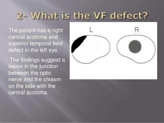 Common Cases: Neurological Visual Field defects