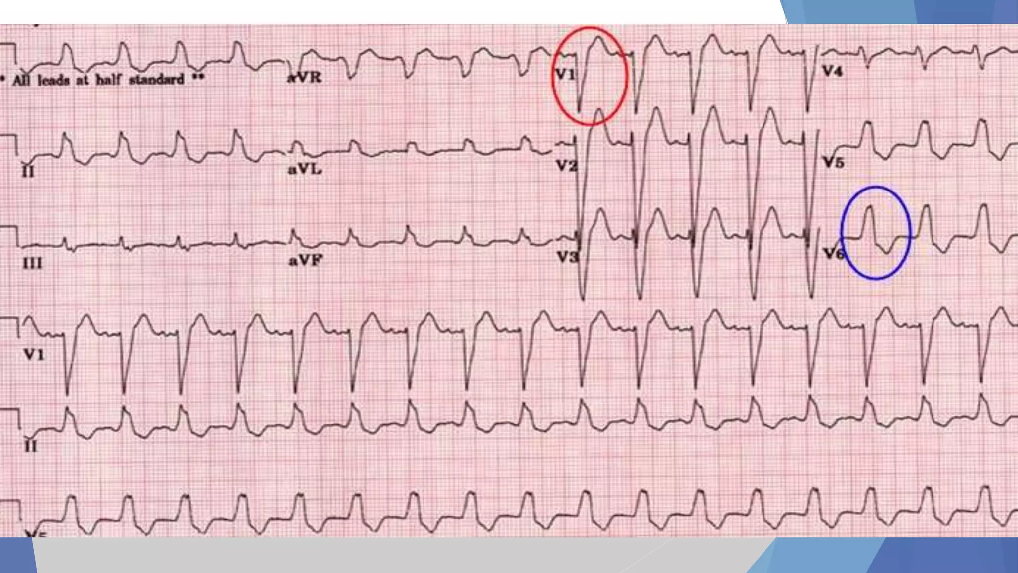 Common chest x rays and common ecgs | PPTX