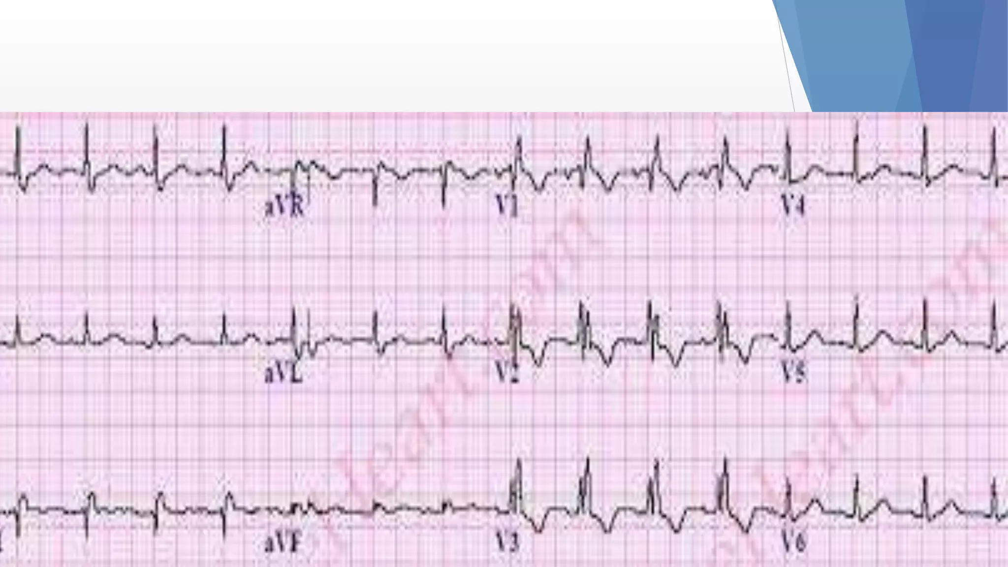 Common chest x rays and common ecgs | PPTX