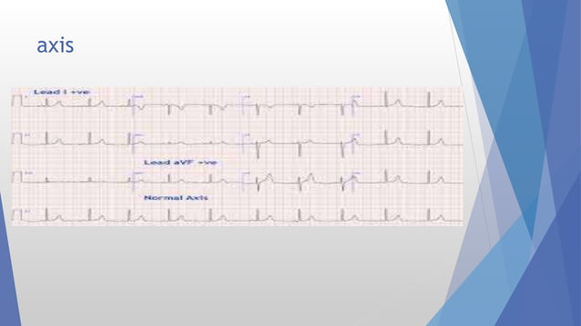 Common chest x rays and common ecgs | PPT