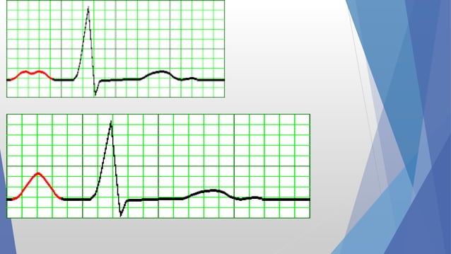 Common chest x rays and common ecgs | PPT