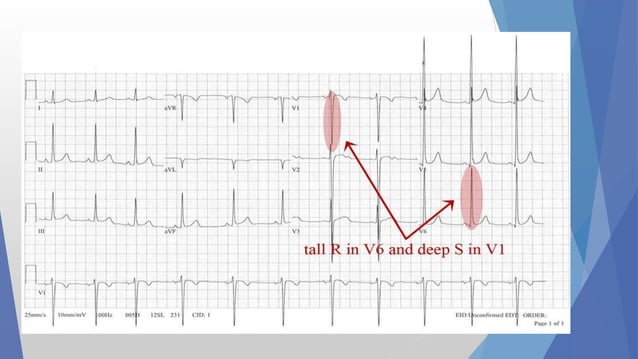 Common chest x rays and common ecgs | PPT