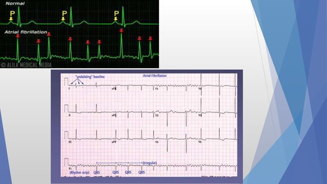 Common chest x rays and common ecgs | PPT