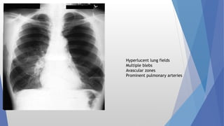 Common chest x rays and common ecgs | PPTX