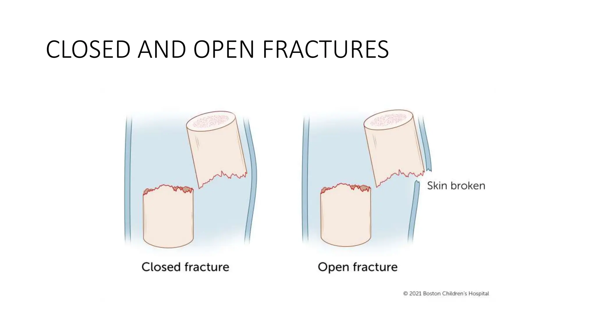 COMMON CHILDHOOD FRACTURES. .pptx