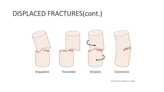 COMMON CHILDHOOD FRACTURES. .pptx