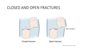 COMMON CHILDHOOD FRACTURES. .pptx