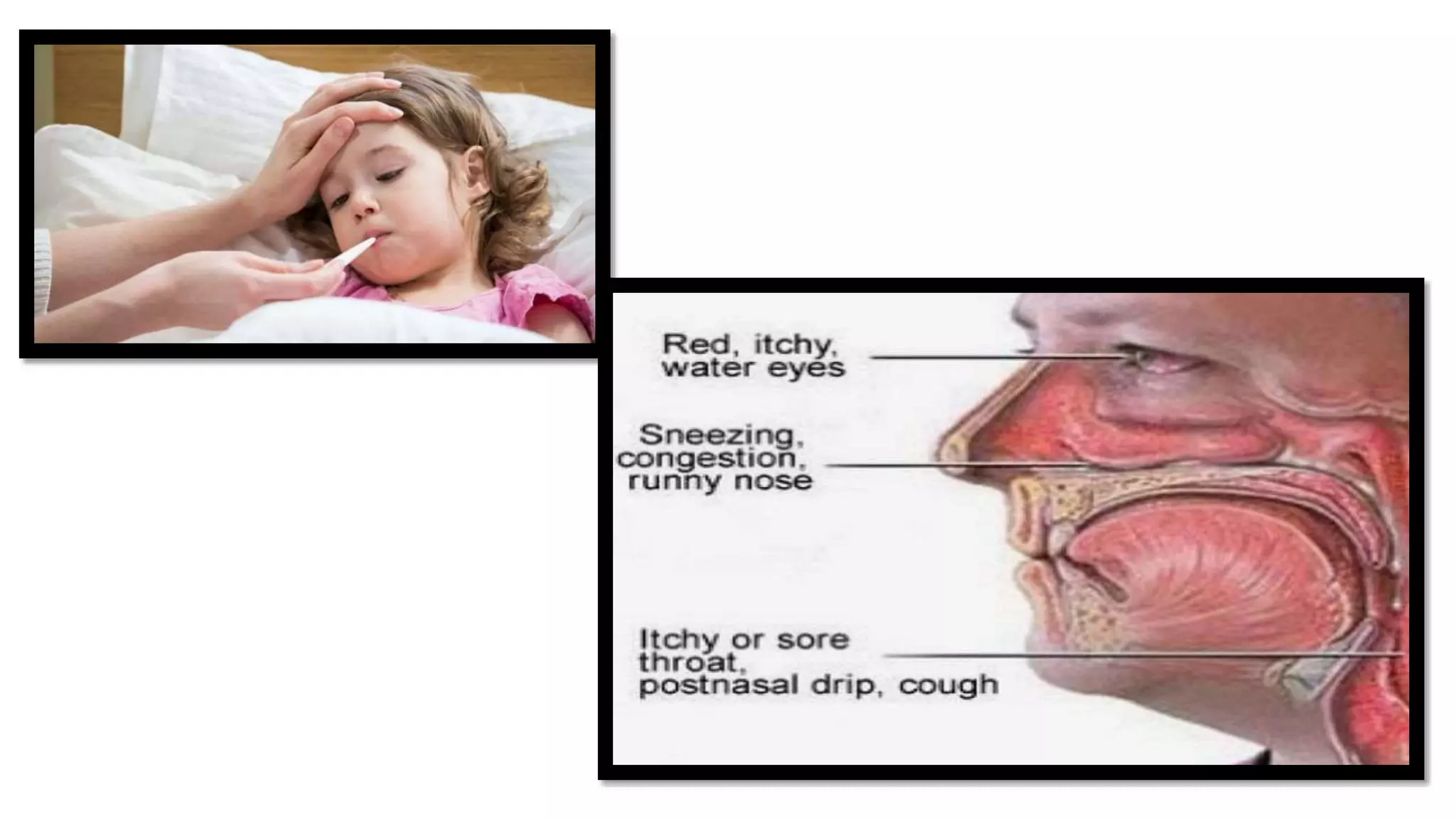 Common cold or nasopharyngitis in children | PPTX