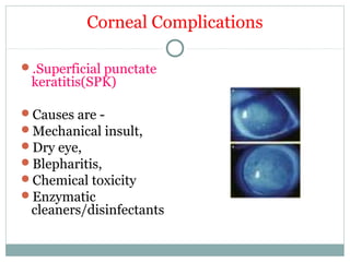 Frequently Encountered complications of RGP Contact Lenses | PPT