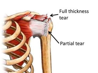 Full thickness rotator cuff tears, Value of clinical tests | PPTX