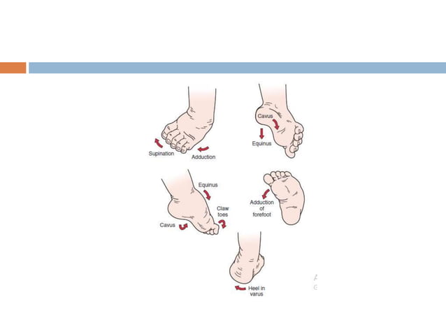 Common deformities, deviations, and injuries of ankle and foot | PPTX