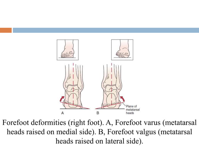 Common deformities, deviations, and injuries of ankle and foot | PPTX