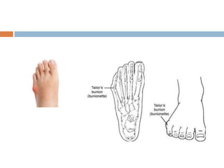 Common deformities, deviations, and injuries of ankle and foot | PPTX