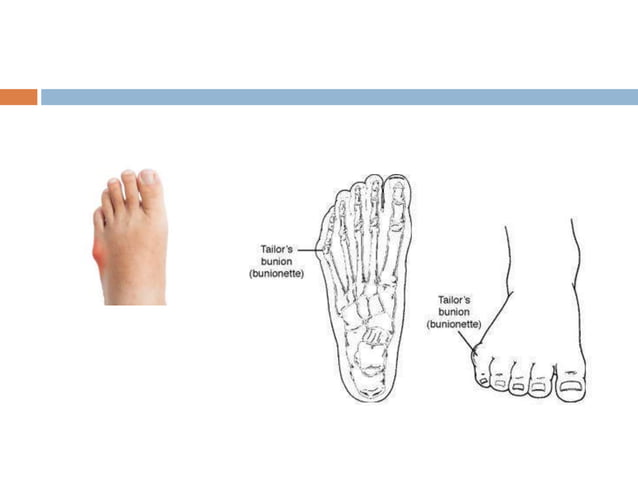Common deformities, deviations, and injuries of ankle and foot | PPTX