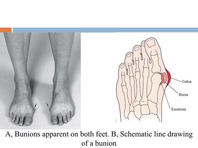Common deformities, deviations, and injuries of ankle and foot | PPTX