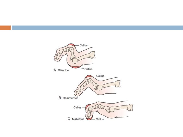Common deformities, deviations, and injuries of ankle and foot | PPTX