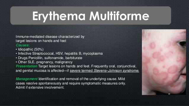 Erythema Chronicum Migrans Vs Erythema Multiforme