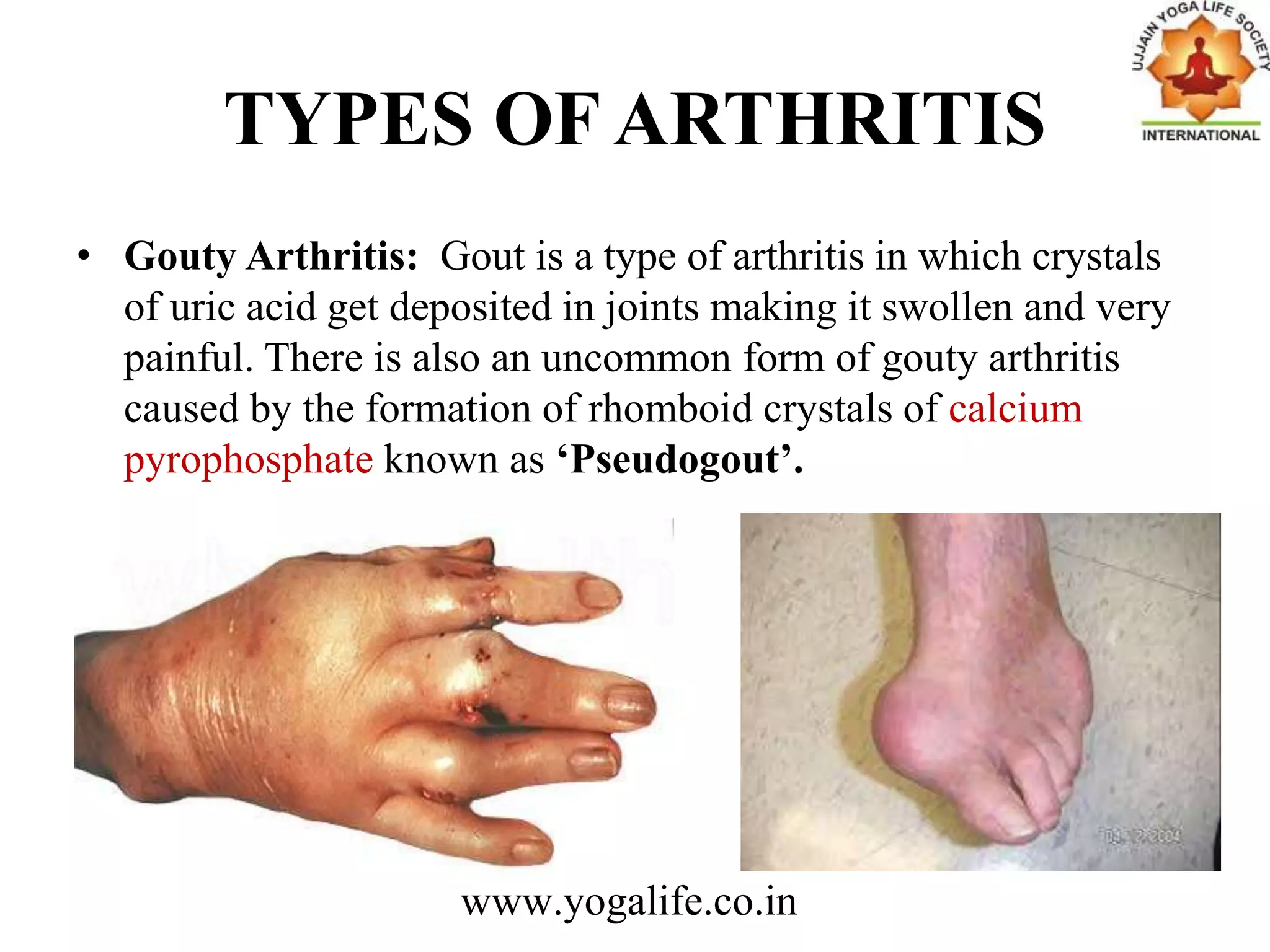 Yoga for orthopedic arthritis and osteoporosis | PPTX | Bone and Joint Conditions | Diseases and ...