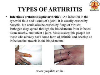 Yoga for orthopedic arthritis and osteoporosis | PPTX | Bone and Joint ...