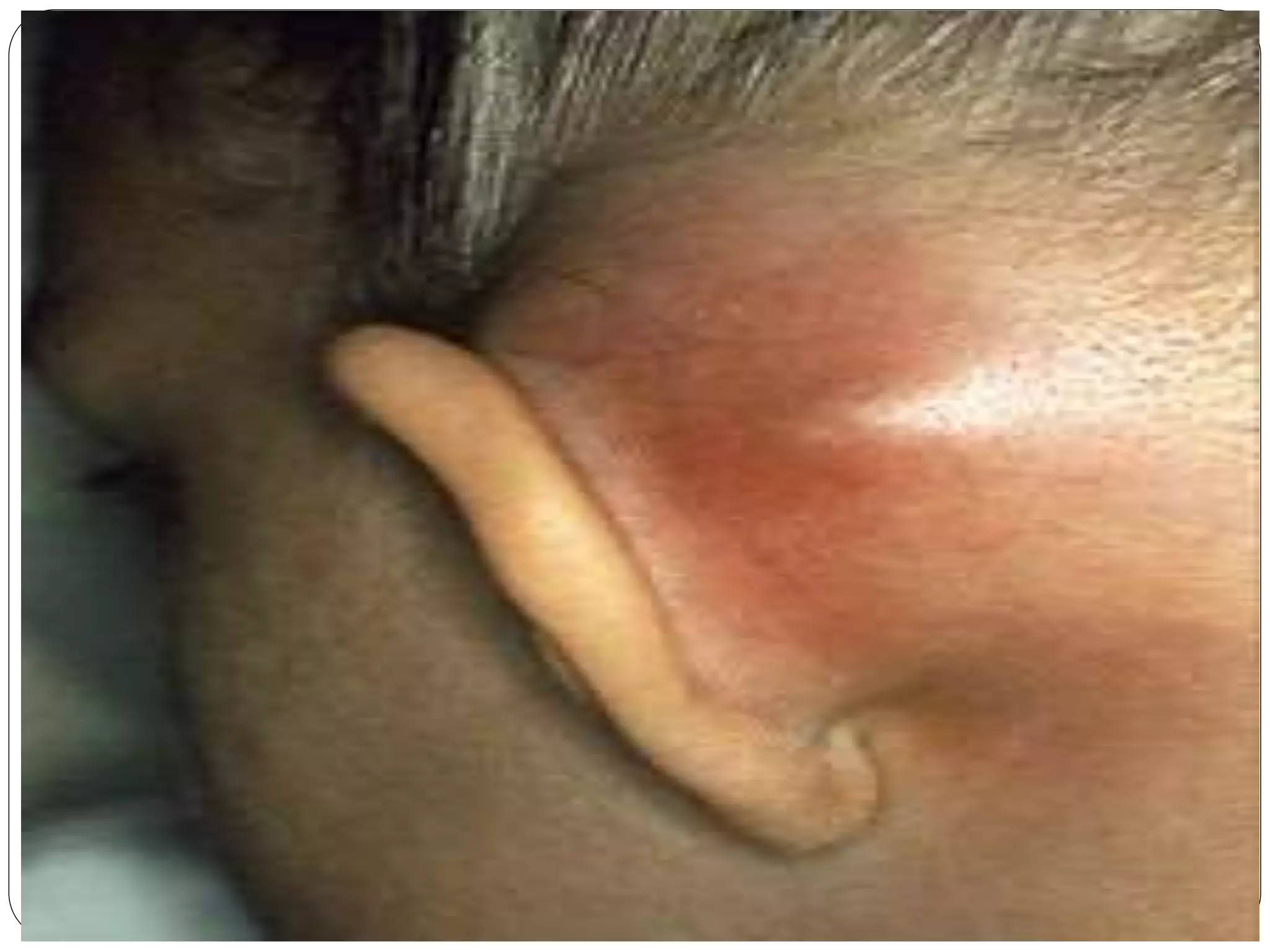 Types Of Common Ear Diseases. | PPT