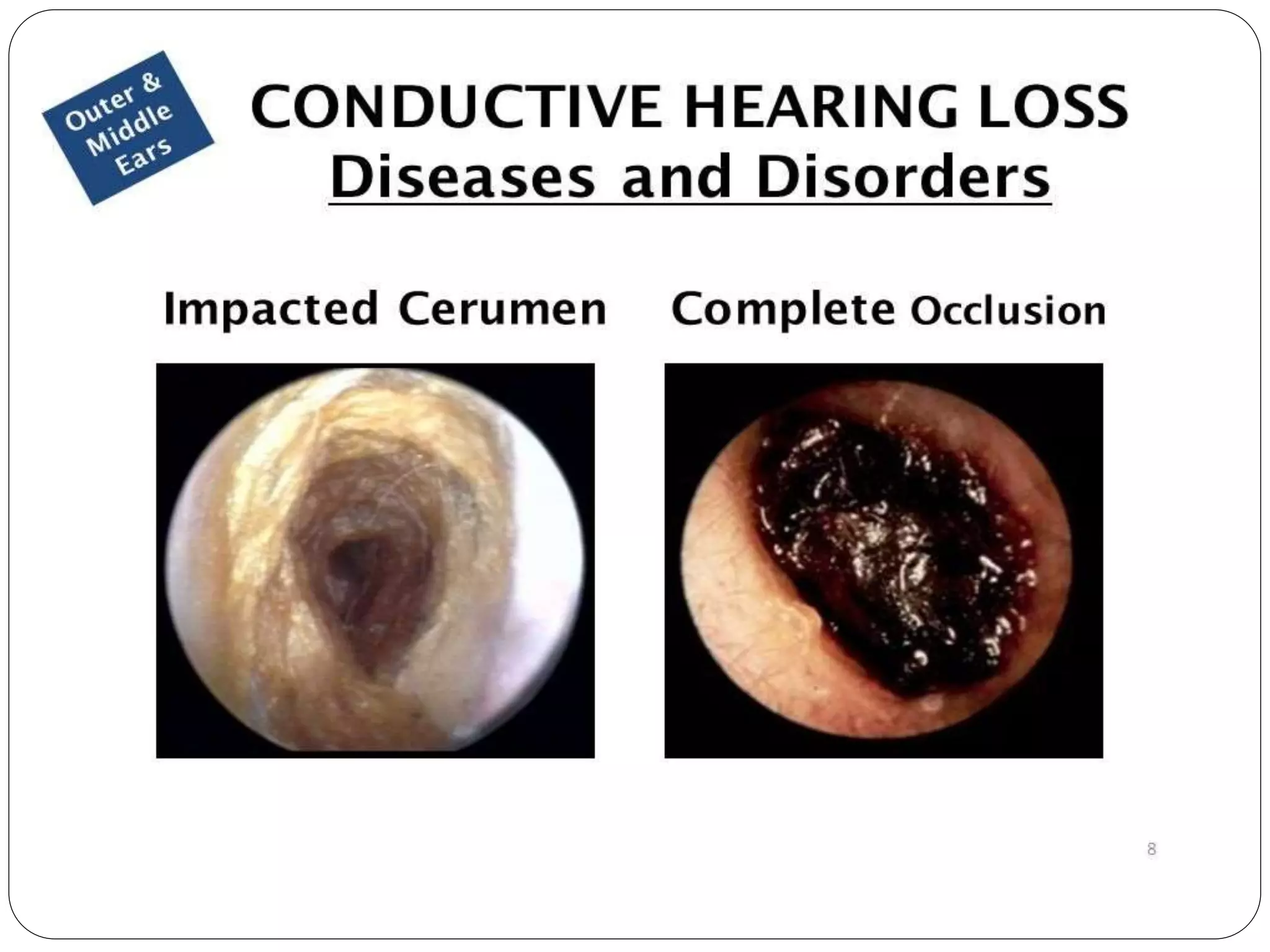 Types Of Common Ear Diseases. | PPT