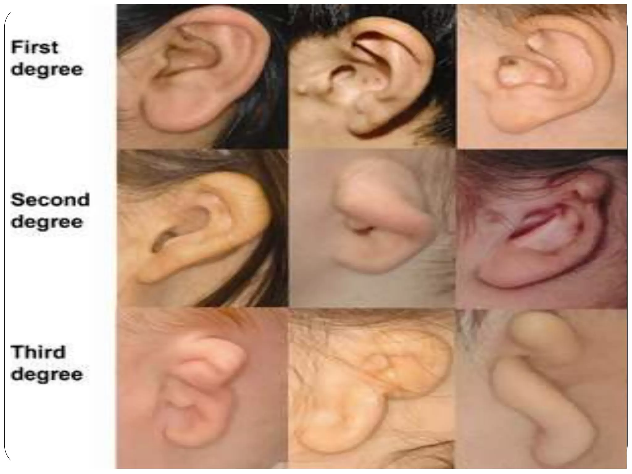 Types Of Common Ear Diseases. | PPT