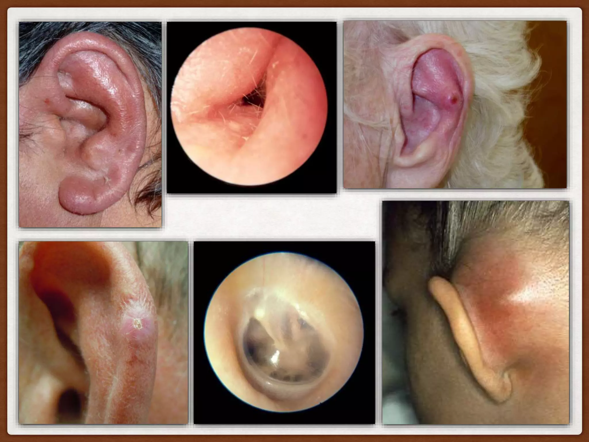 Common ear disorders | PPTX