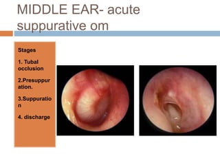 Common ent disorders | PPTX