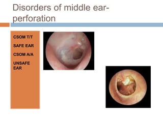 Common ent disorders | PPTX
