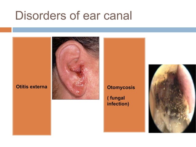 Common ent disorders | PPTX