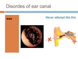 Common ent disorders | PPTX