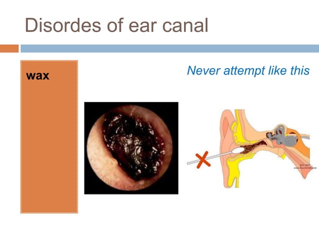 Common ent disorders | PPTX