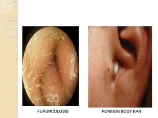 common ear nose throat PROBLEMS seen in opd | PPTX