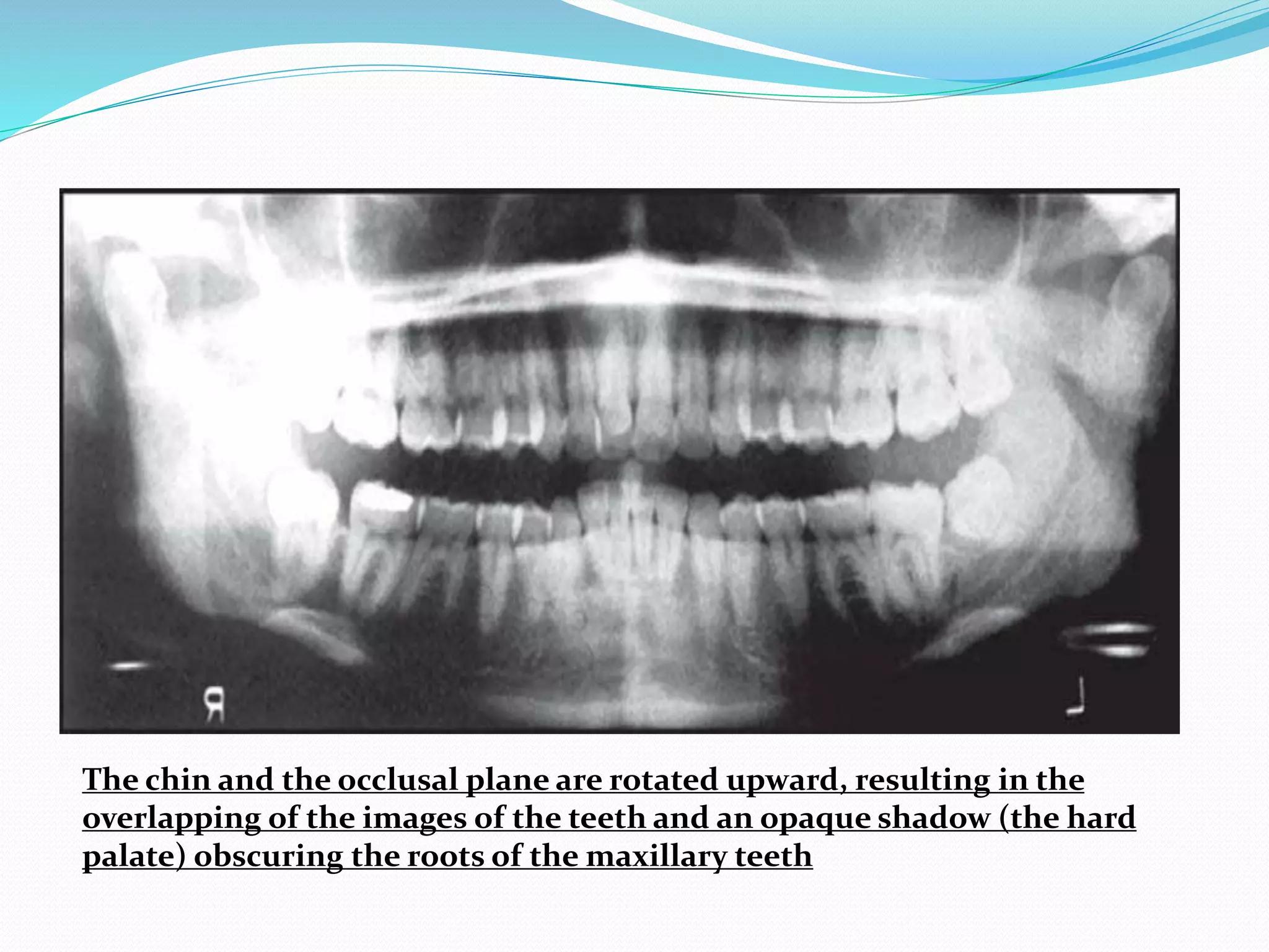 Common errors in opg | PPTX