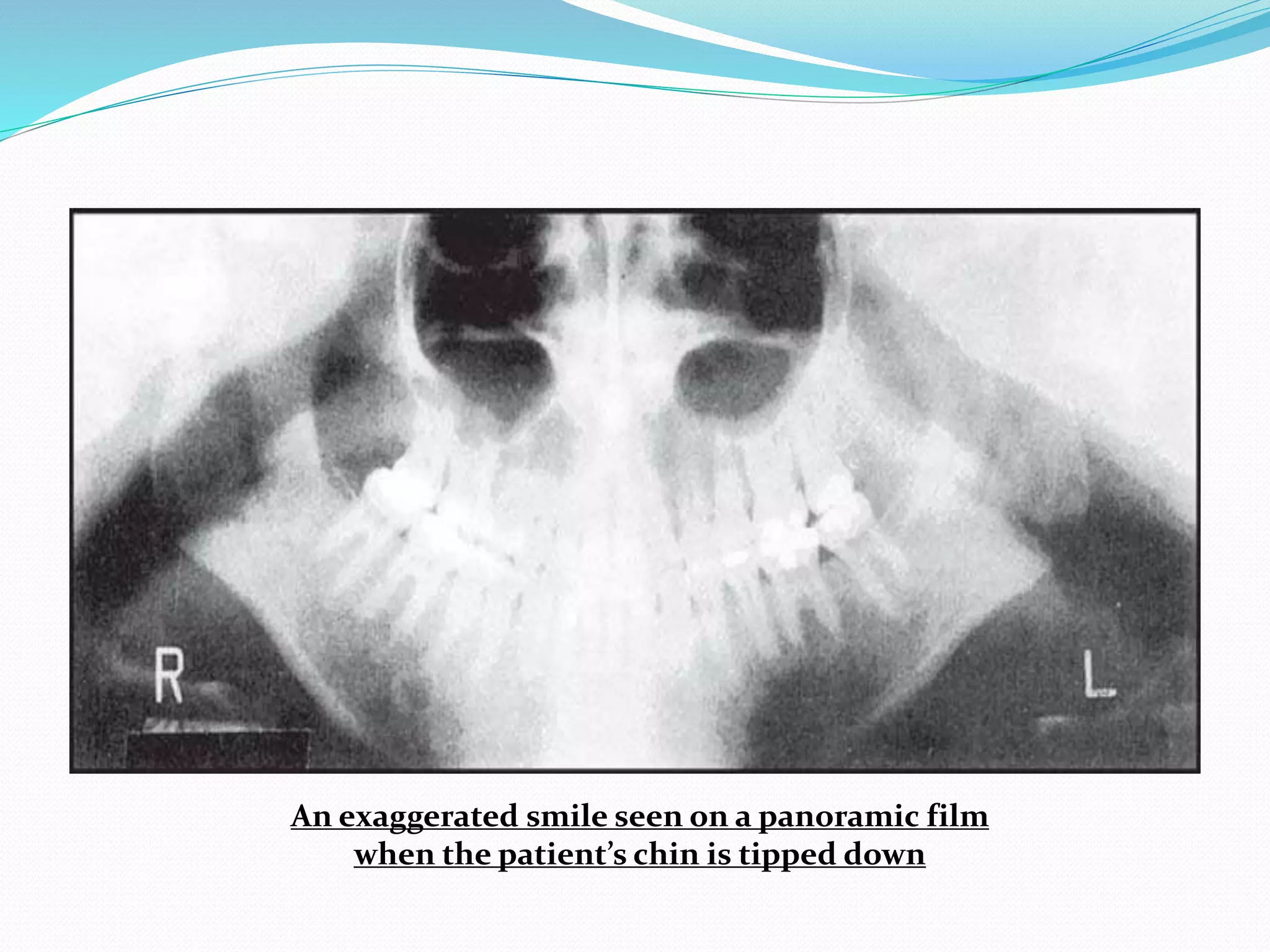 Common errors in opg | PPTX