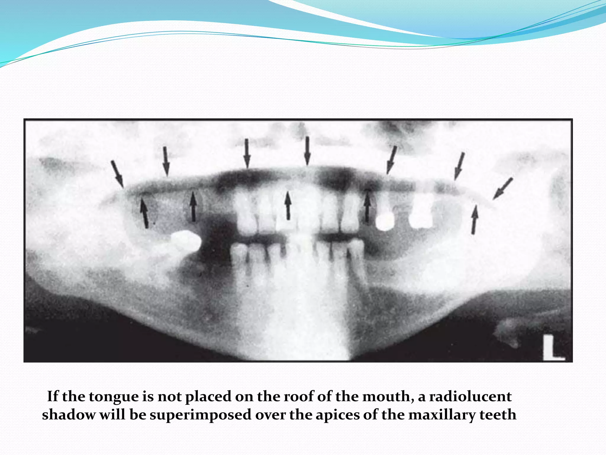Common errors in opg | PPTX