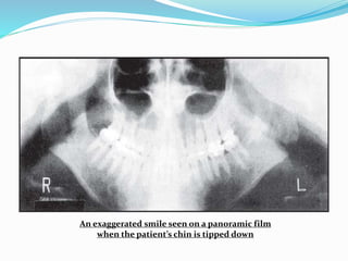 Common errors in opg | PPTX