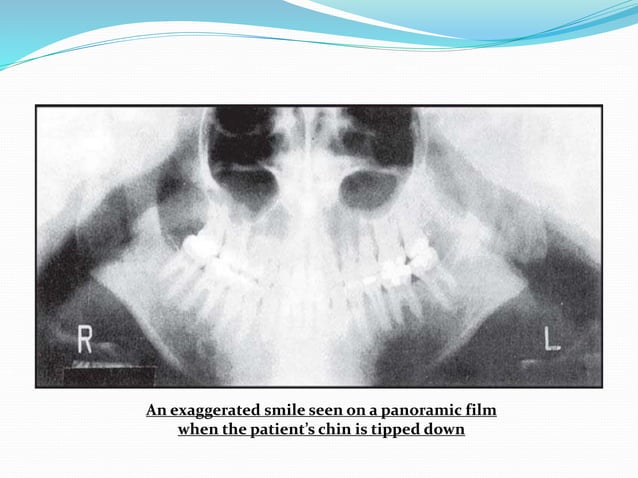 Common errors in opg | PPTX | Dental Health | Diseases and Conditions