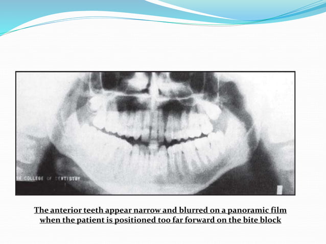 Common errors in opg | PPTX | Dental Health | Diseases and Conditions