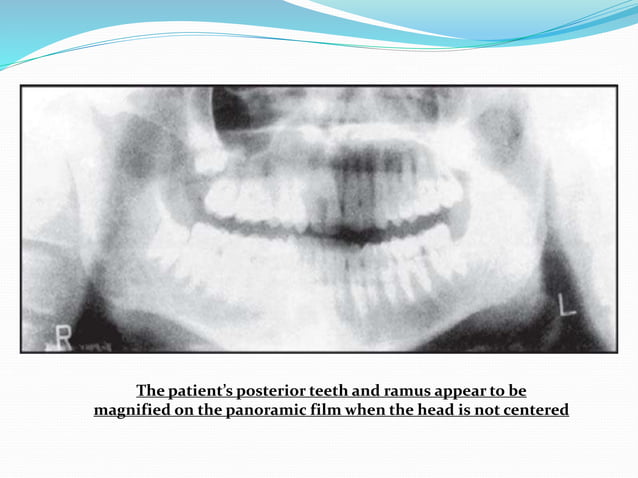 Common errors in opg | PPTX | Dental Health | Diseases and Conditions