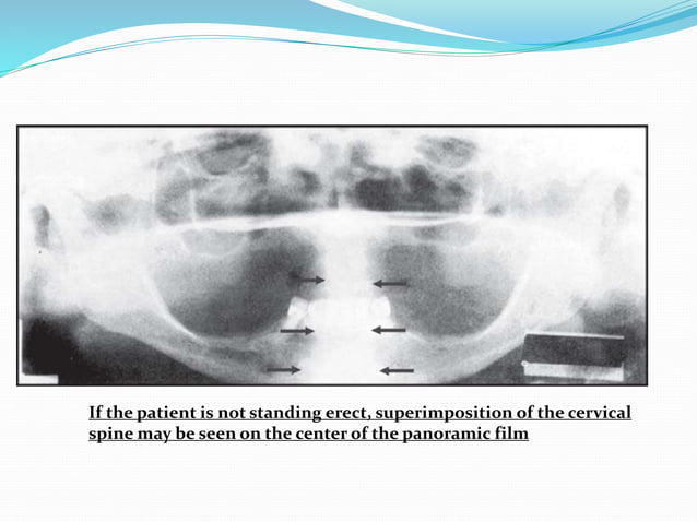 Common errors in opg | PPTX | Dental Health | Diseases and Conditions