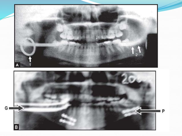 Common errors in opg | PPTX | Dental Health | Diseases and Conditions