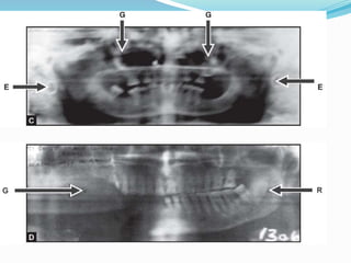 Common errors in opg | PPTX