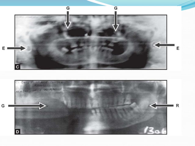 Common errors in opg | PPTX | Dental Health | Diseases and Conditions
