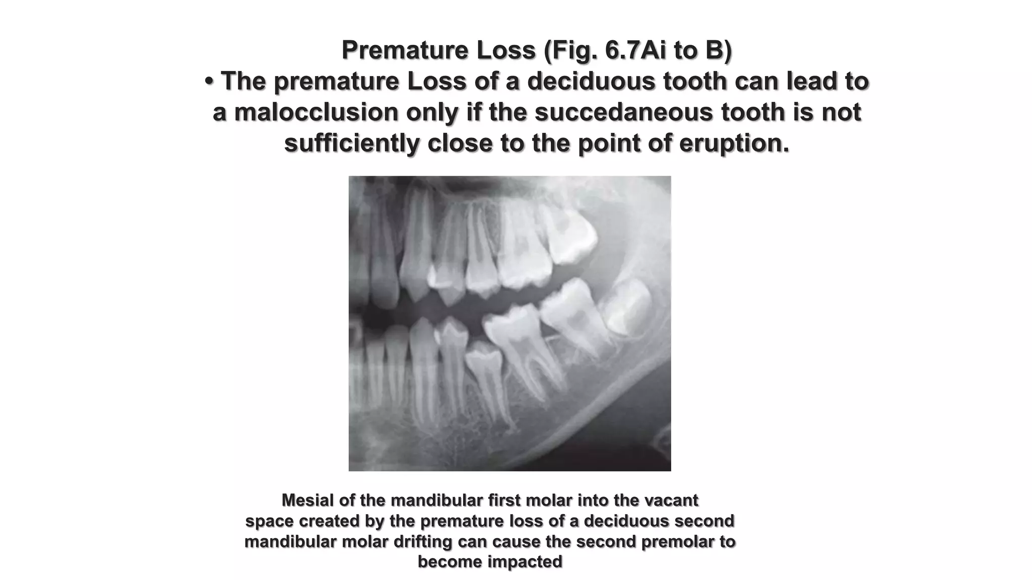 Common etiological factors of malocclusion | PPTX