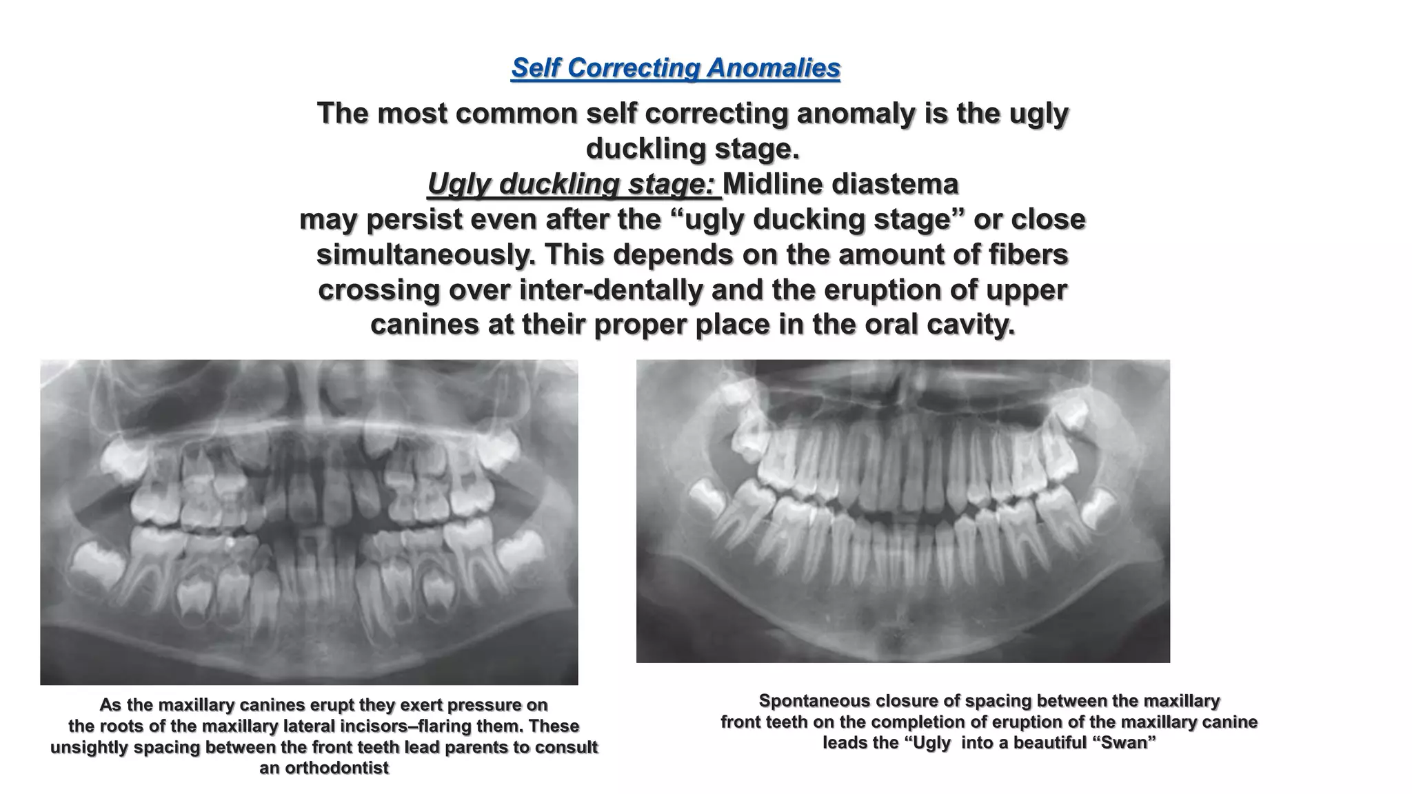 Common etiological factors of malocclusion | PPTX