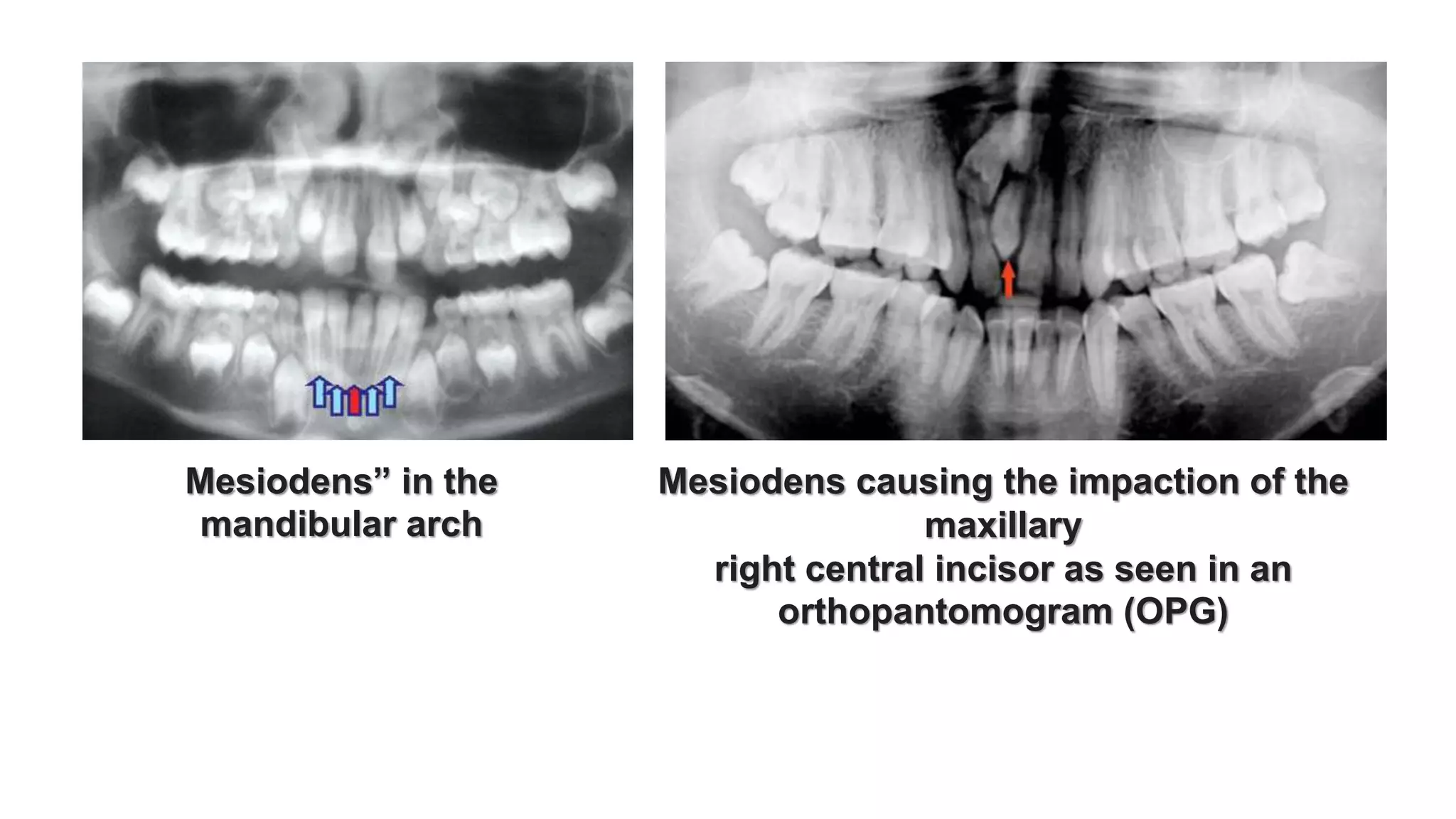 Common etiological factors of malocclusion | PPTX