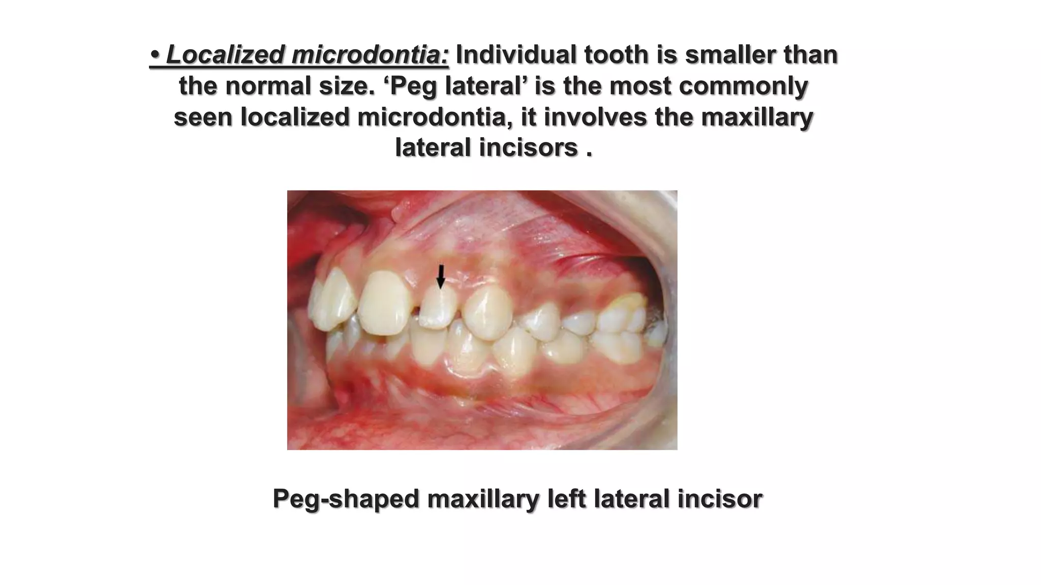 Common etiological factors of malocclusion | PPTX