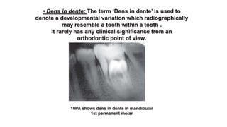 Common etiological factors of malocclusion | PPTX